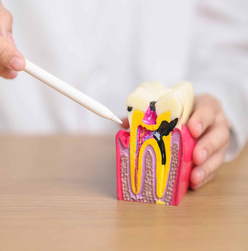 Root Canal Therapy Katy, TX — Cinco Ranch Dental